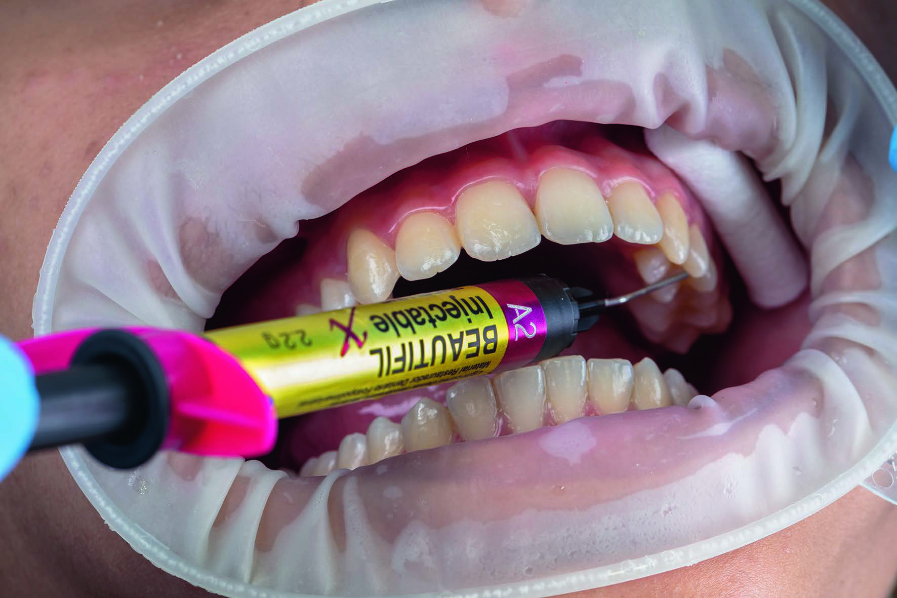 کامپوزیت زیرو فلو Beautifil Injectable X شوفو - شرکت آوا طب برنا